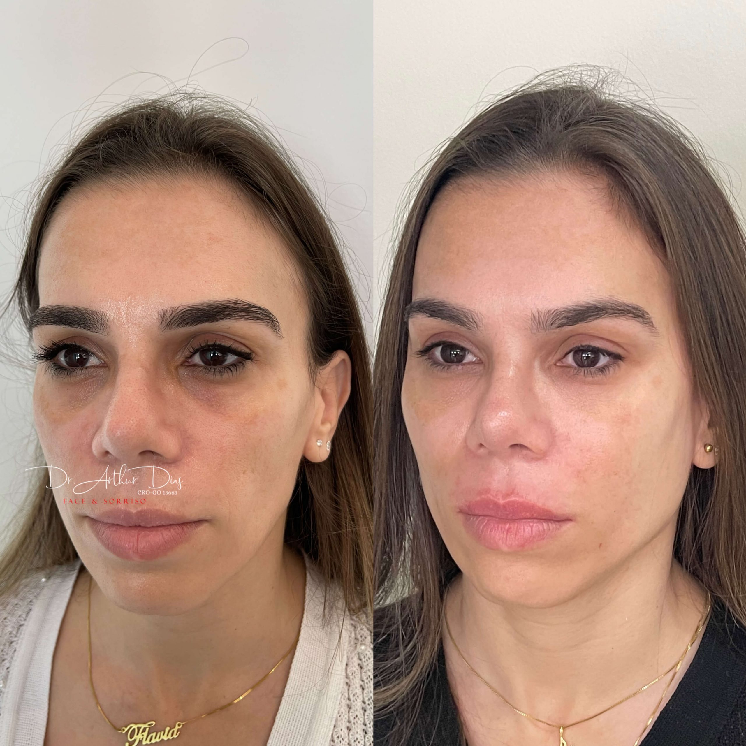 Preenchimento Facial com Ácido Hialurônico - Dr. Arthur Dias